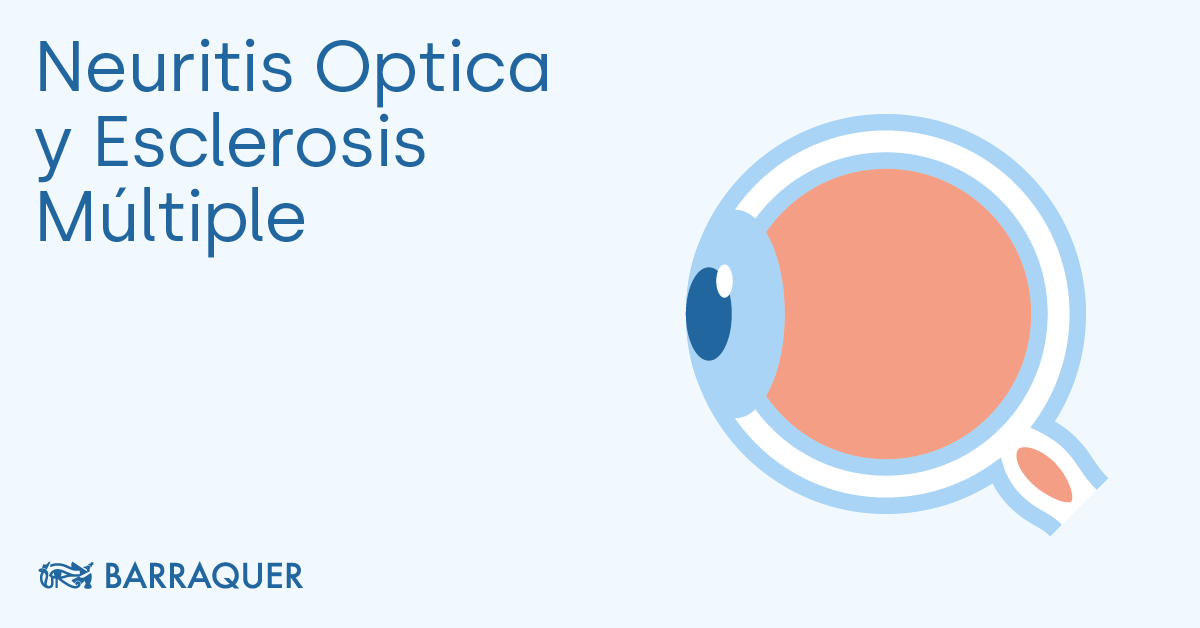 Névrite optique de la sclérose en plaques - Barraquer