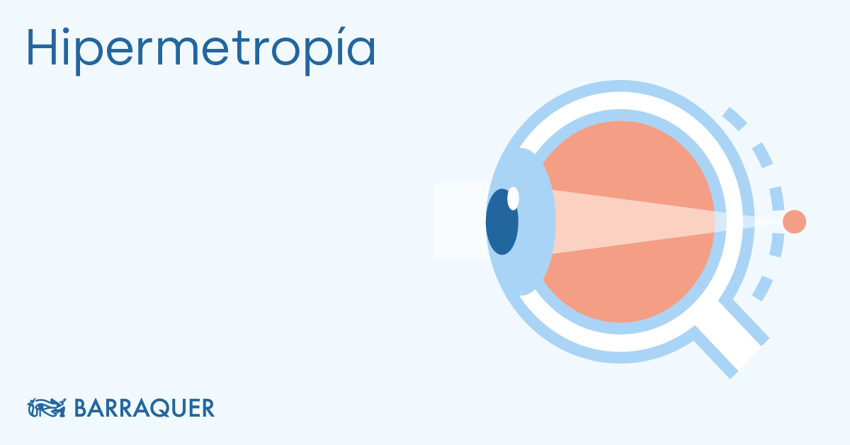Hypermetropia (long-sightedness) | What it is, symptoms and treatment ...