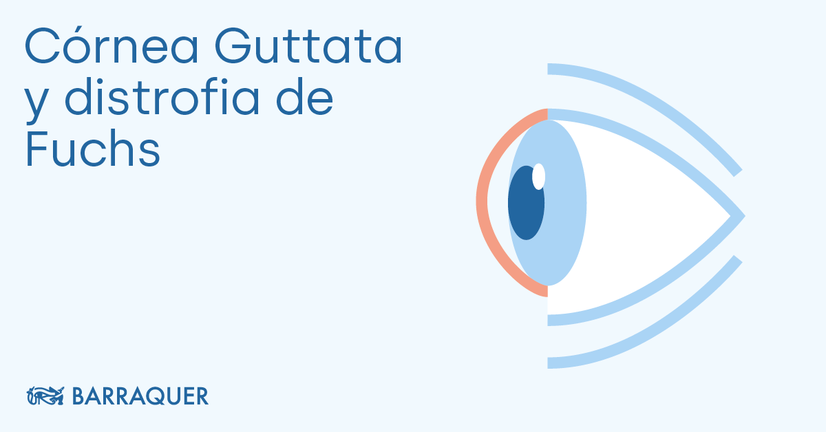 Guttate Cornea and Fuchs' Dystrophy | Symptoms and Treatment - Barraquer