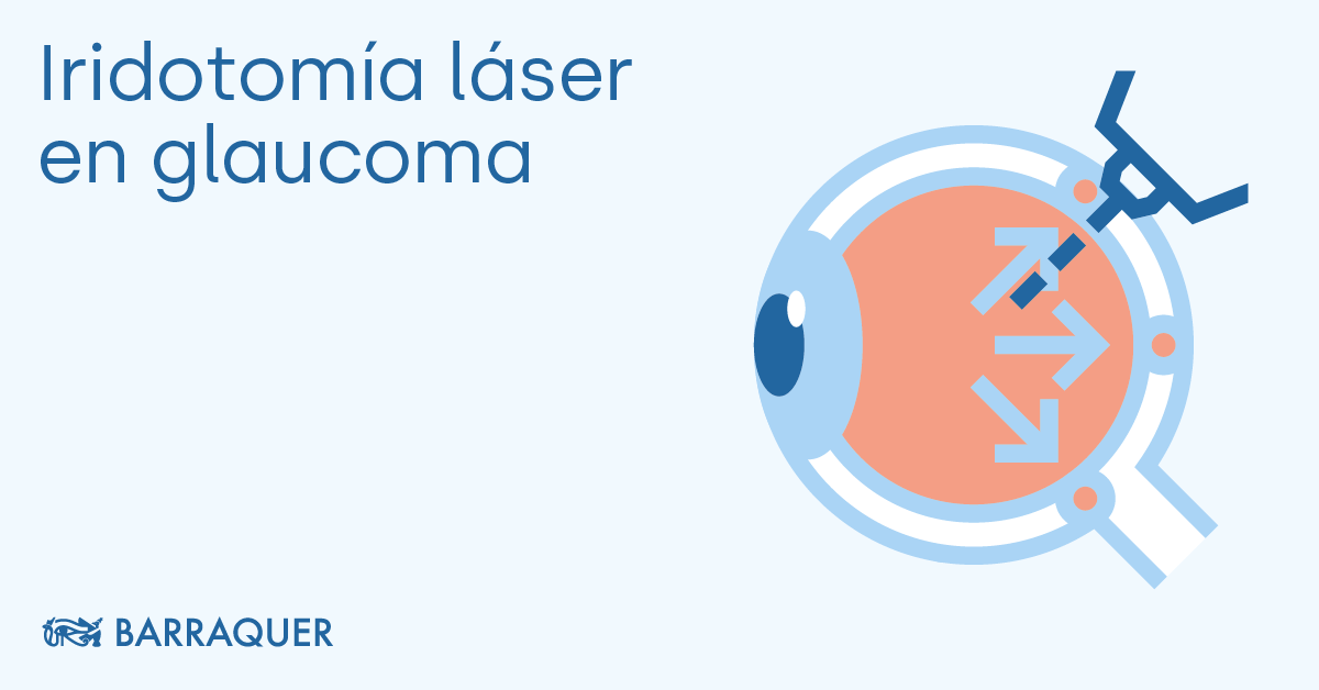 Laser iridotomy technique for glaucoma - Barraquer Ophthalmology Centre