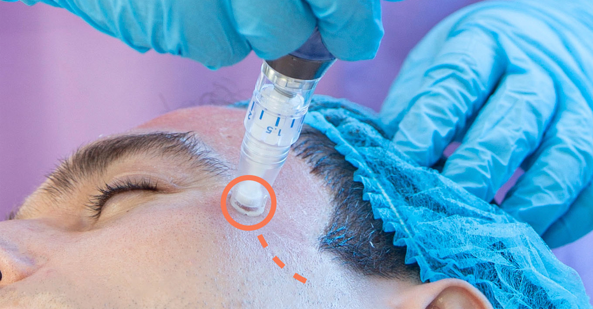 How do we perform facial mesotherapy? | Barraquer