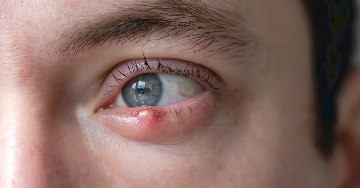 Orzuelo: Síntomas, Causas, Tratamiento Y Prevención – SQPSDH