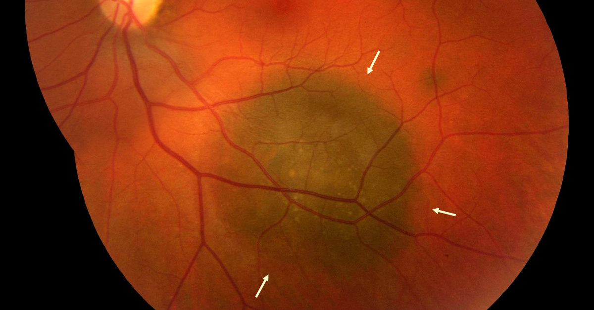 Moles or nevus in the back of the eye. Should we be worried?