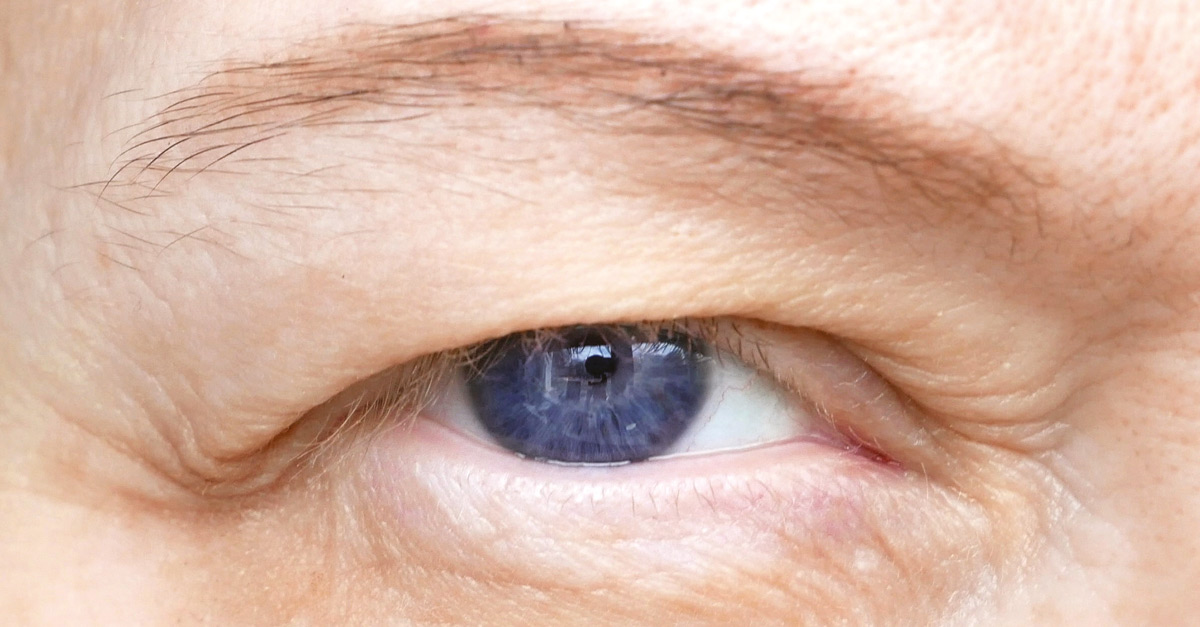 Todo sobre la piel de alrededor de los ojos y los párpados “caídos”