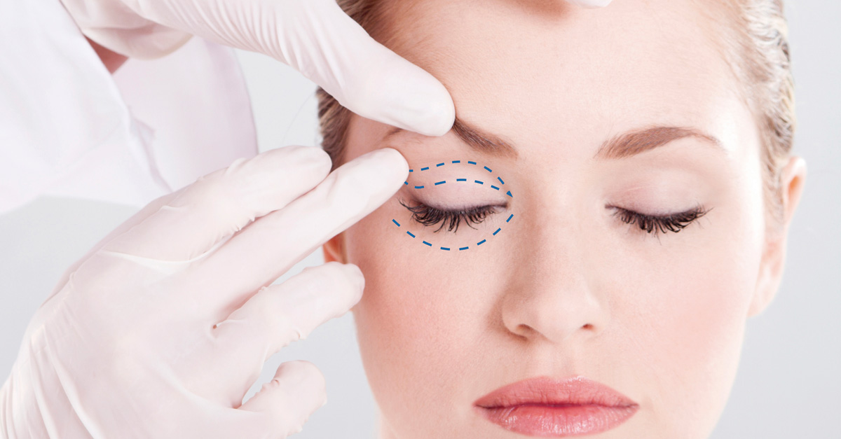 Blefaroláser: nueva técnica para la blefaroplastia