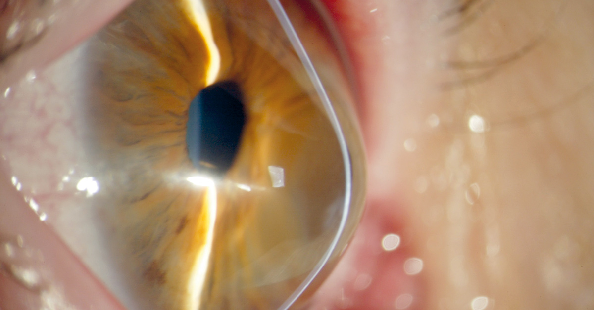 What irregular astigmatism is and how it is treated